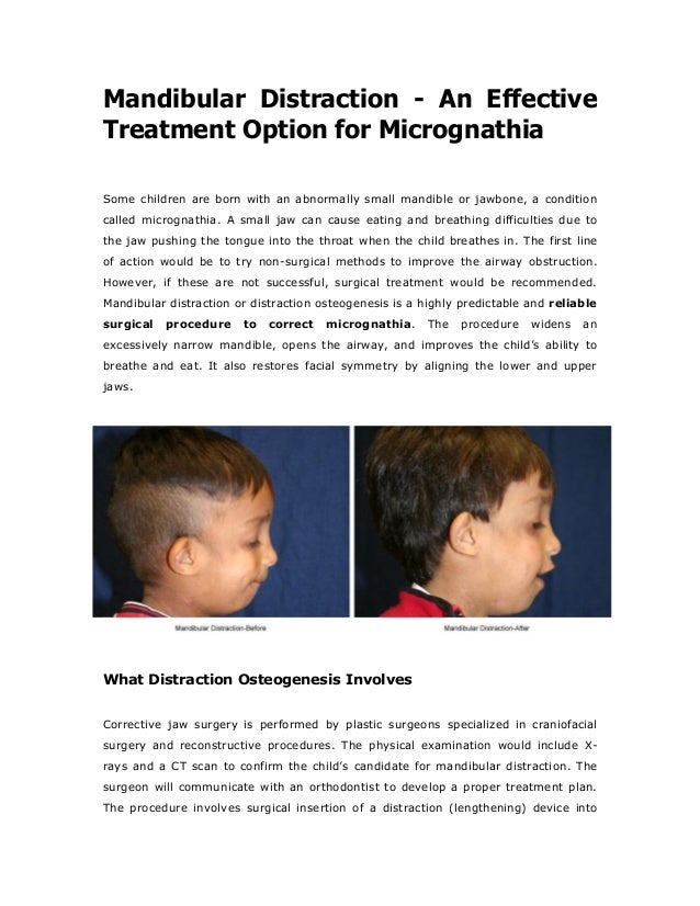Mandibular Distraction - An Effective Treatment Option for Micrognathia
