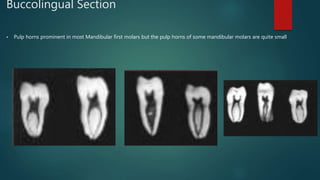 Mandibular first molar pulp canal morphology | PPTX