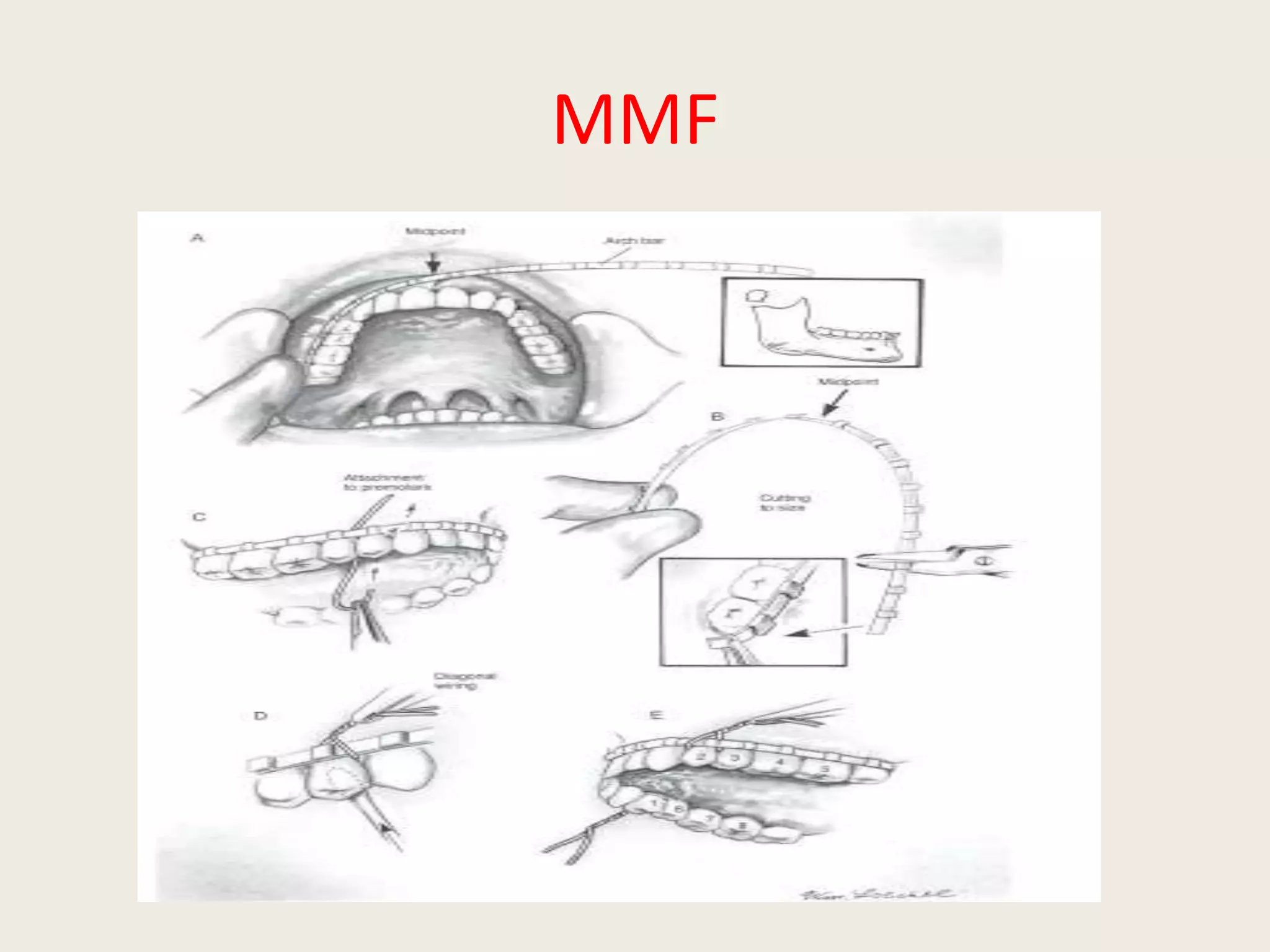 Maxillomandibular fracture | PPTX