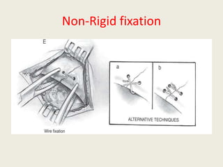 Maxillomandibular fracture | PPTX