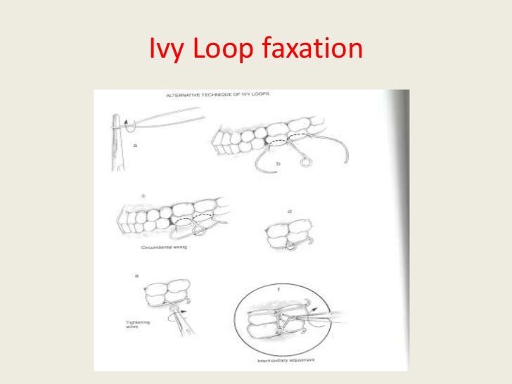 Maxillomandibular fracture