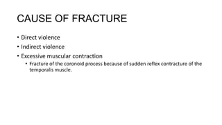 Mandibular fracture | PPTX