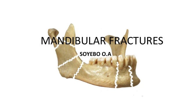 Mandibular fracture
