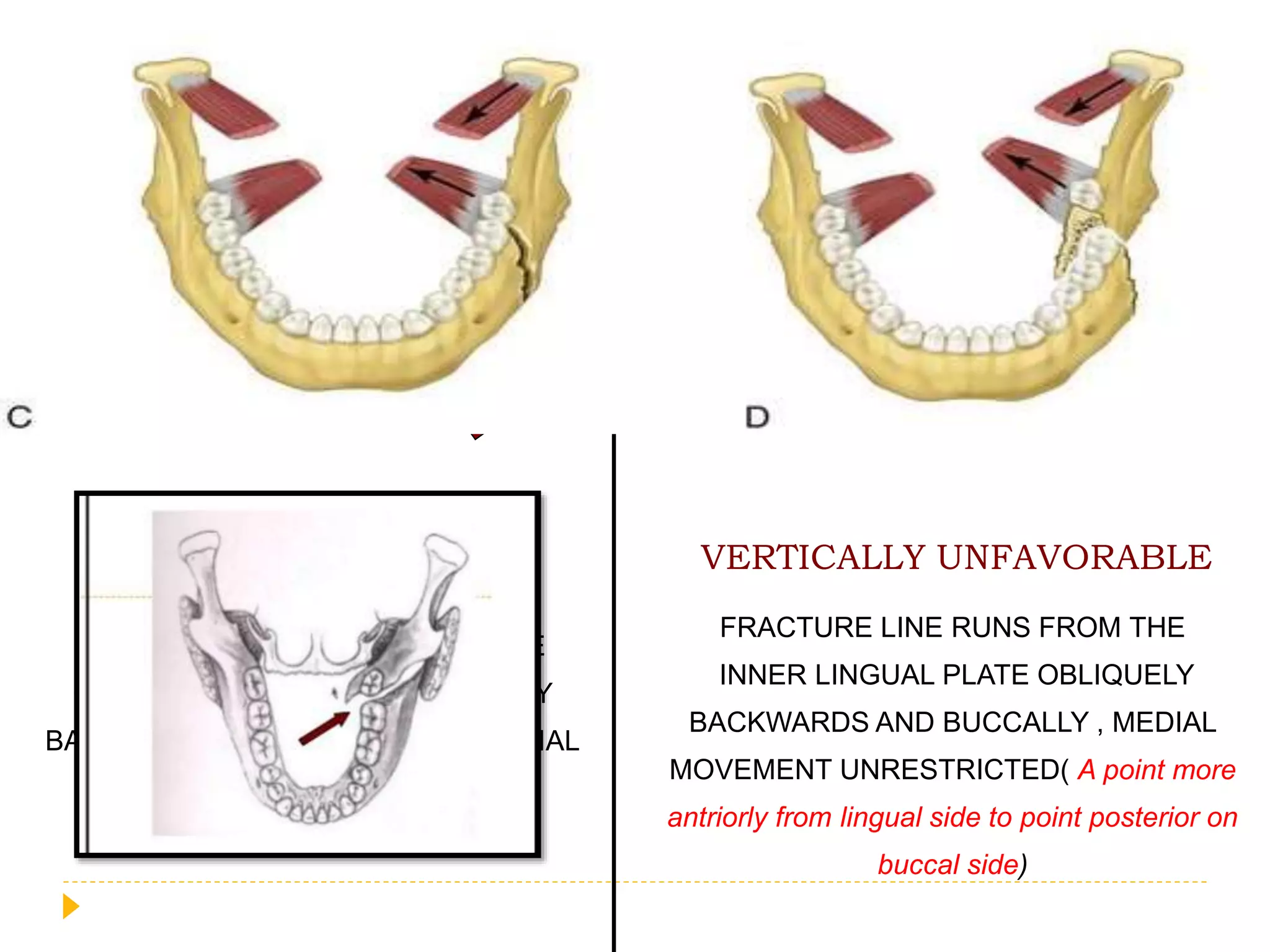 Mandibular fracture | PPTX