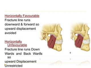 Mandibular fracture | PPTX