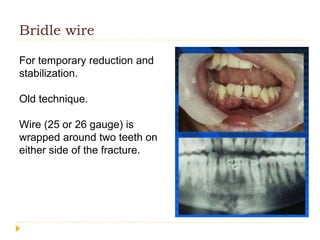 Mandibular fracture | PPTX