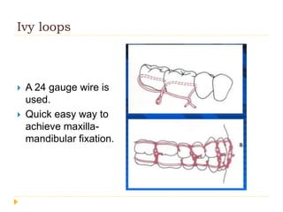 Mandibular fracture | PPTX