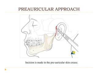 Mandibular fracture | PPTX