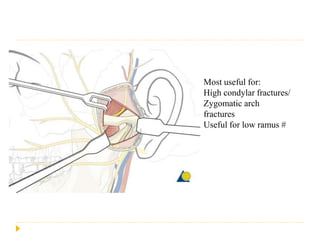 Mandibular fracture | PPTX