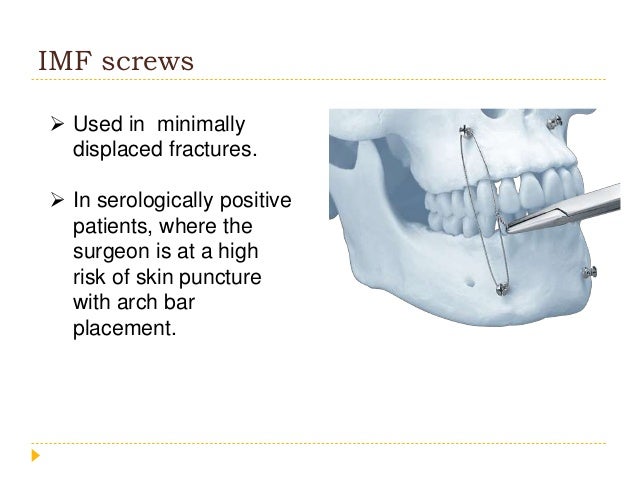 Mandibular fracture
