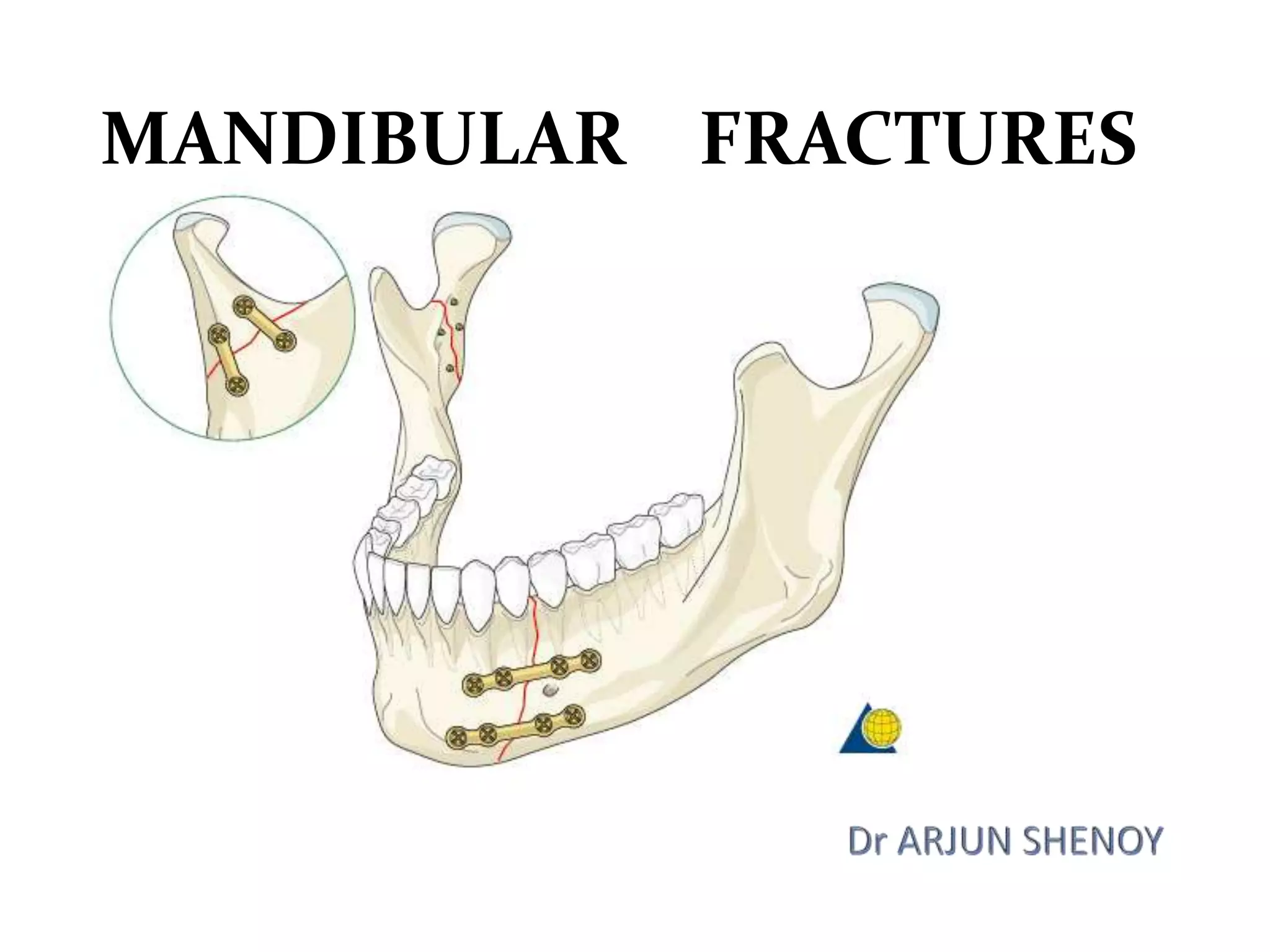 Mandibular fractures | PPTX | Death, Injury, or Military Conflict ...