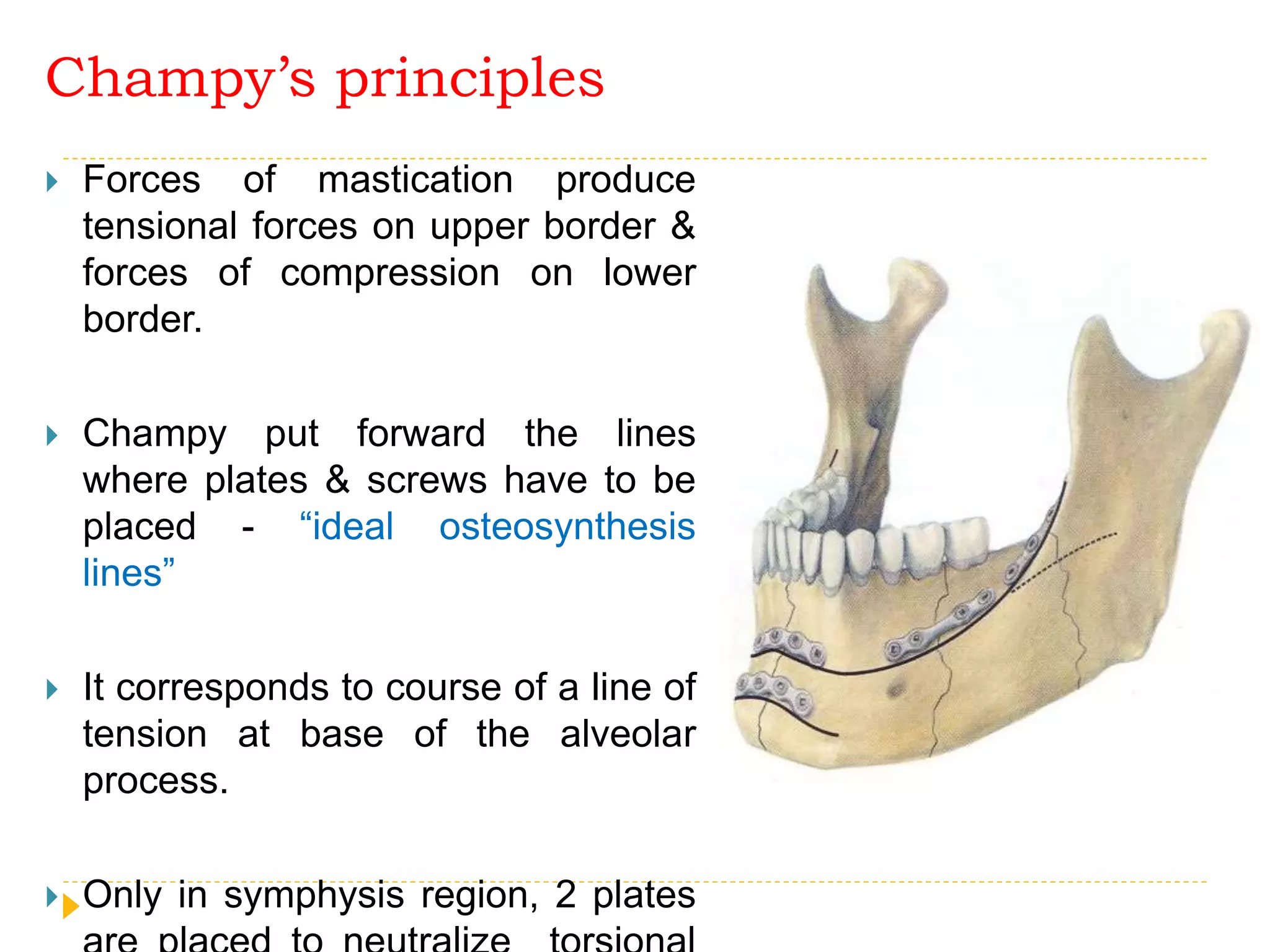 Mandibular fractures | PPTX
