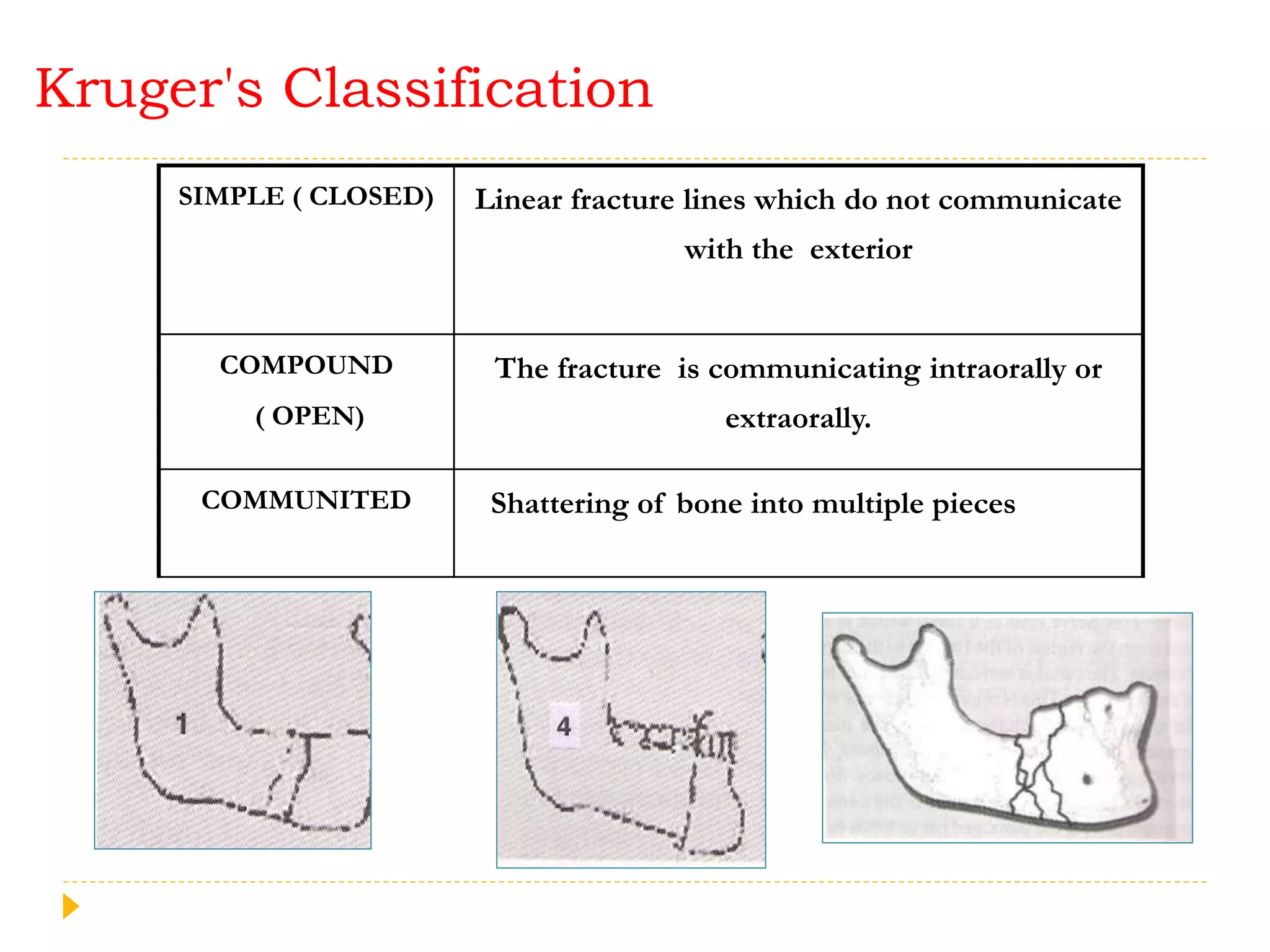 Mandibular fractures | PPTX