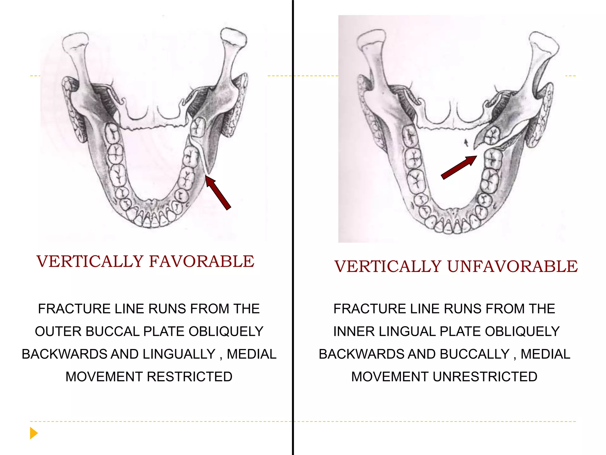 Mandibular fractures | PPTX