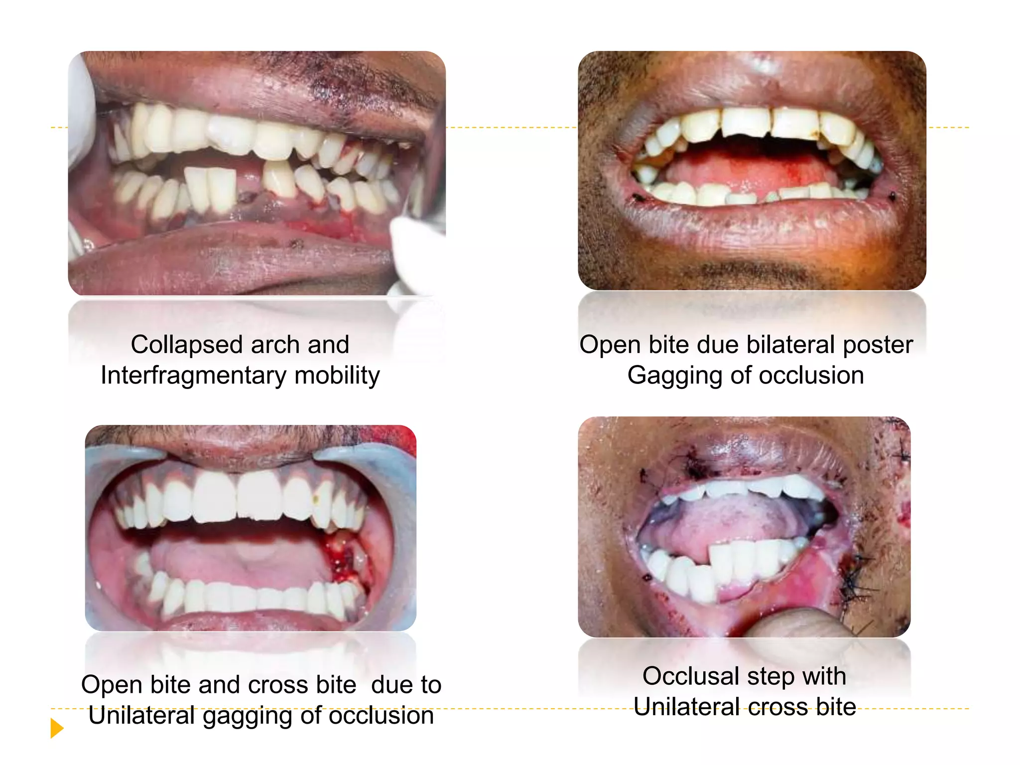 Mandibular fractures | PPTX
