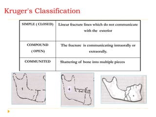 Mandibular fractures | PPTX