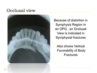 Mandibular fractures | PPTX