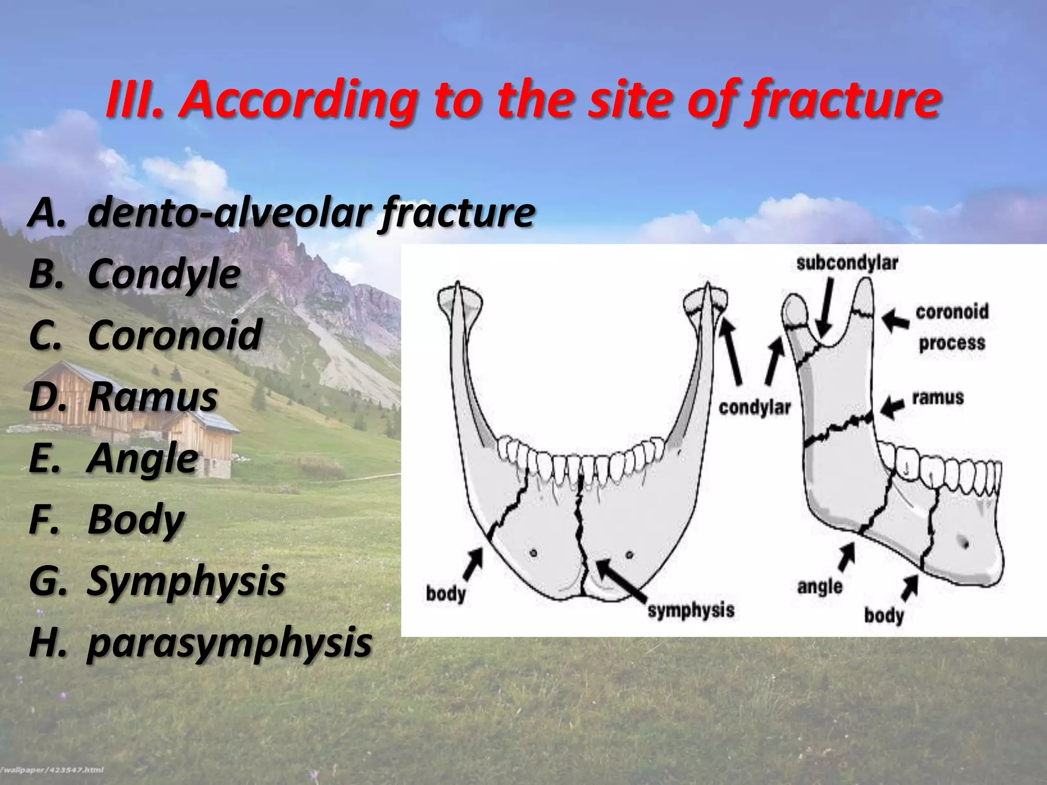 Mandibular fracture | PPSX