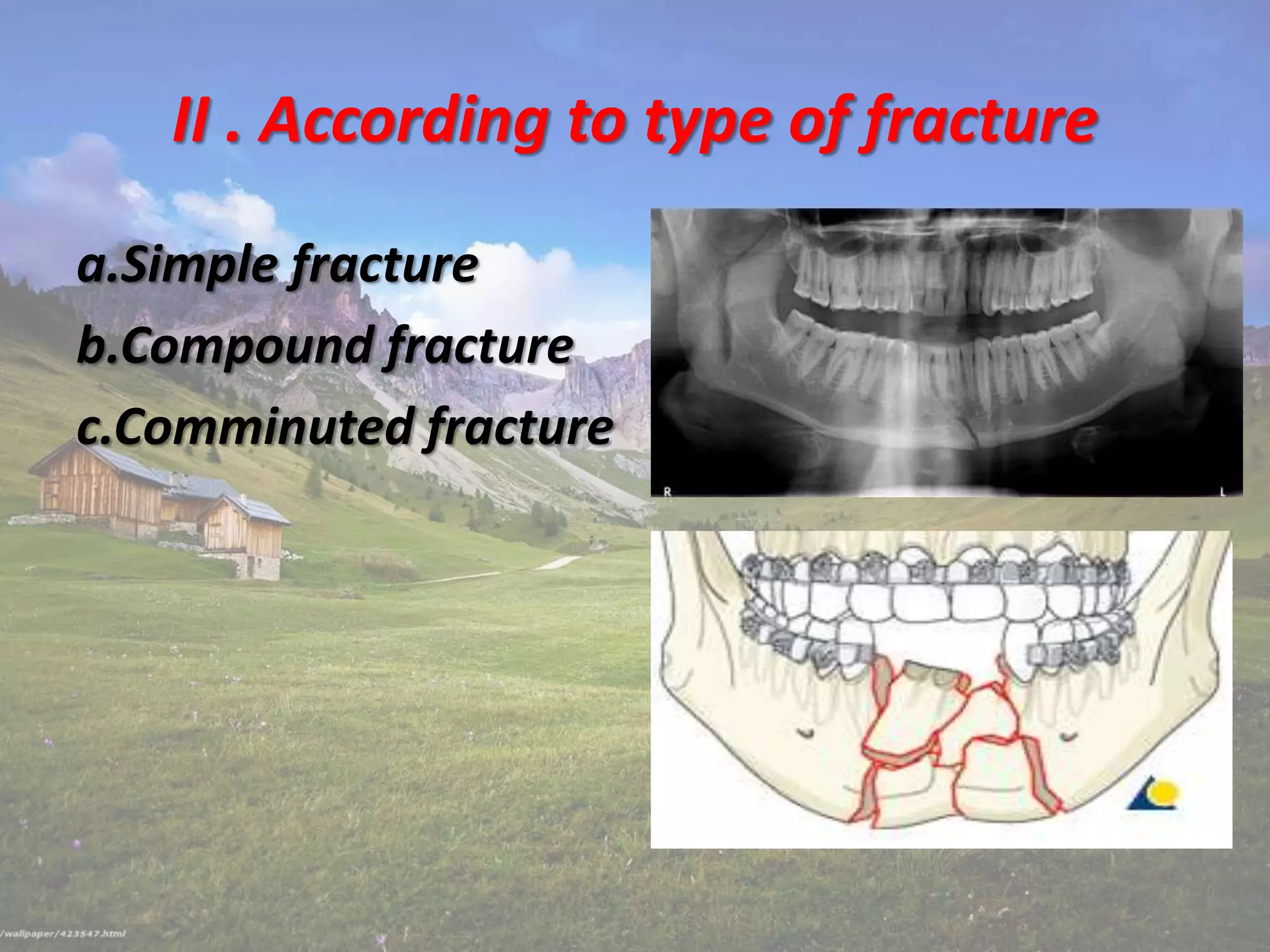 Mandibular fracture | PPSX