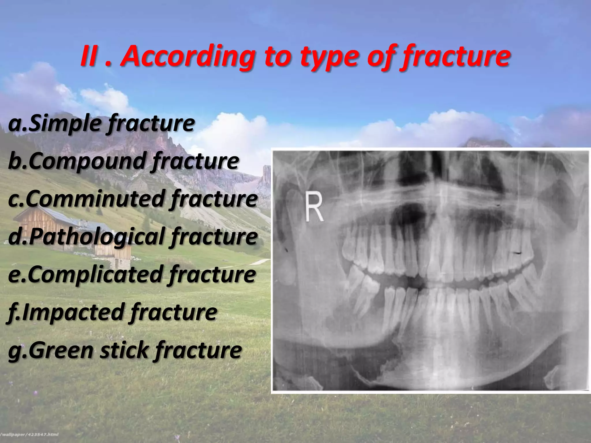 Mandibular fracture | PPSX
