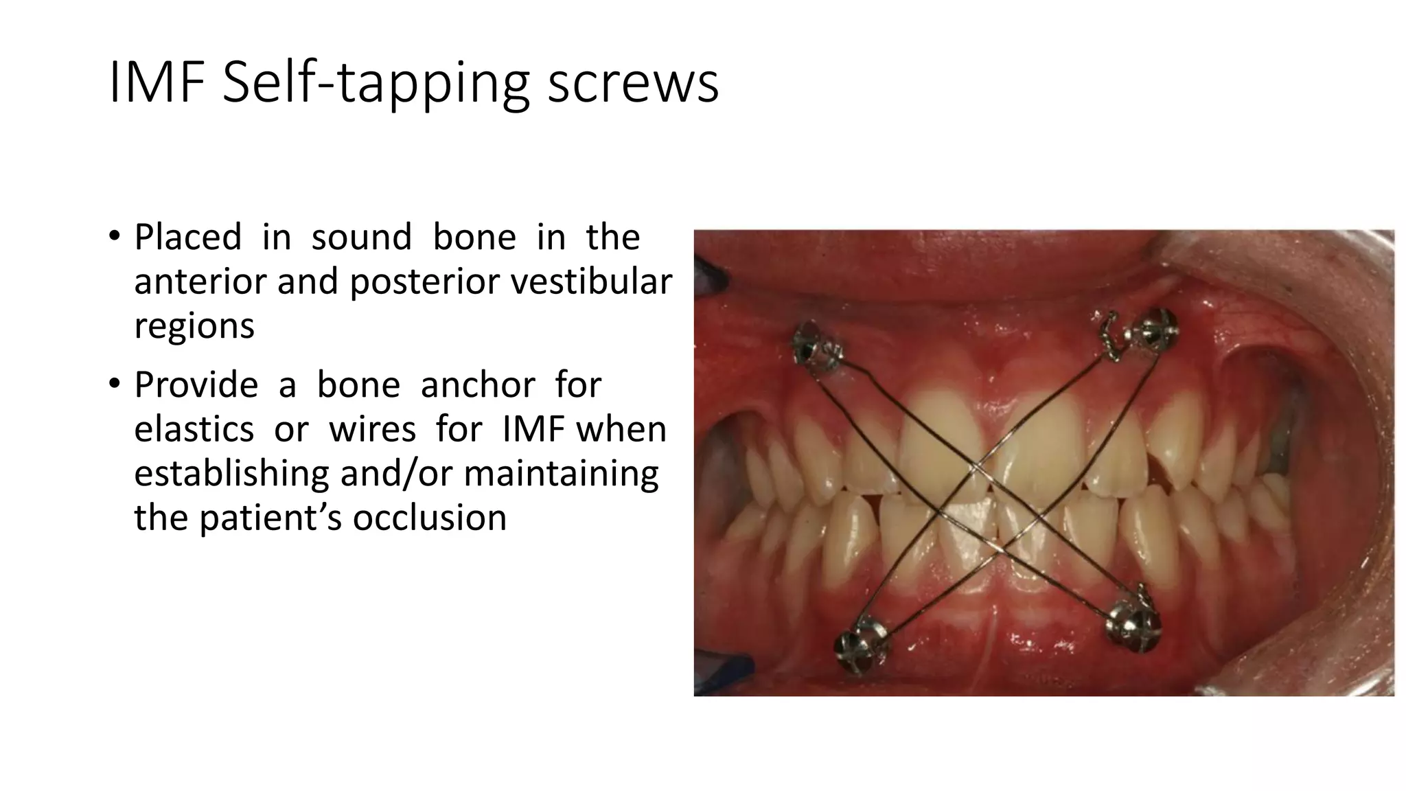 Mandibular fracture- diagnosis | PPTX