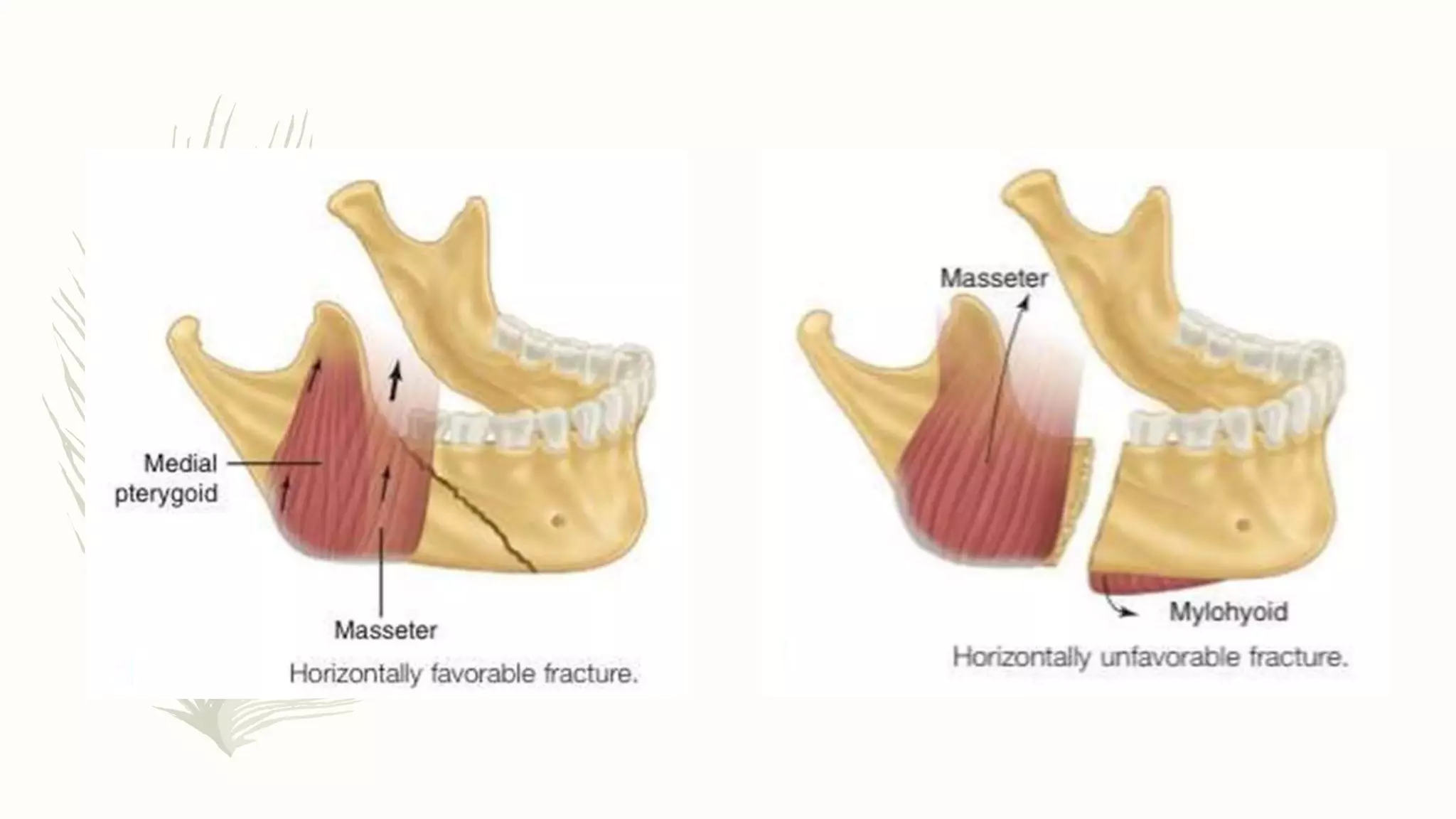 Mandibular Fracture.ppt