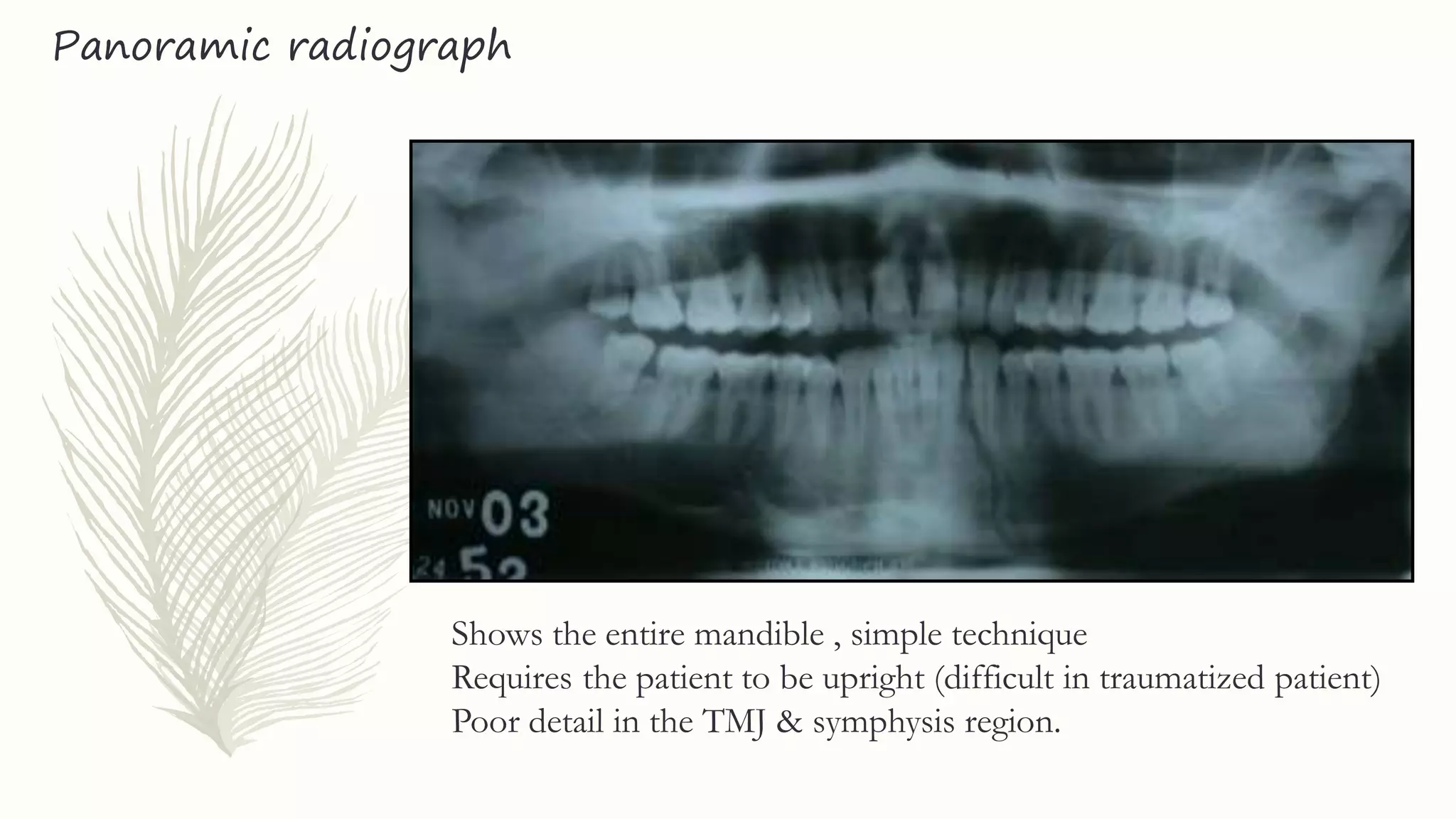 Mandibular Fracture.ppt