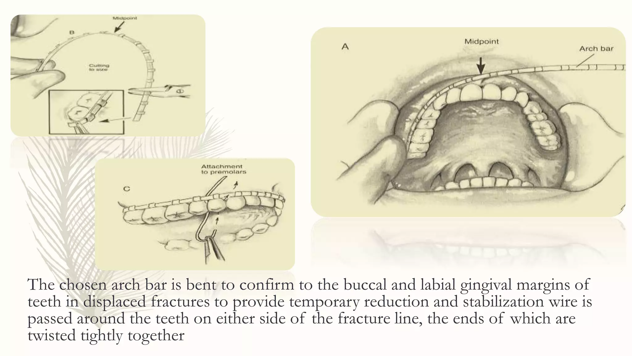 Mandibular Fracture.ppt