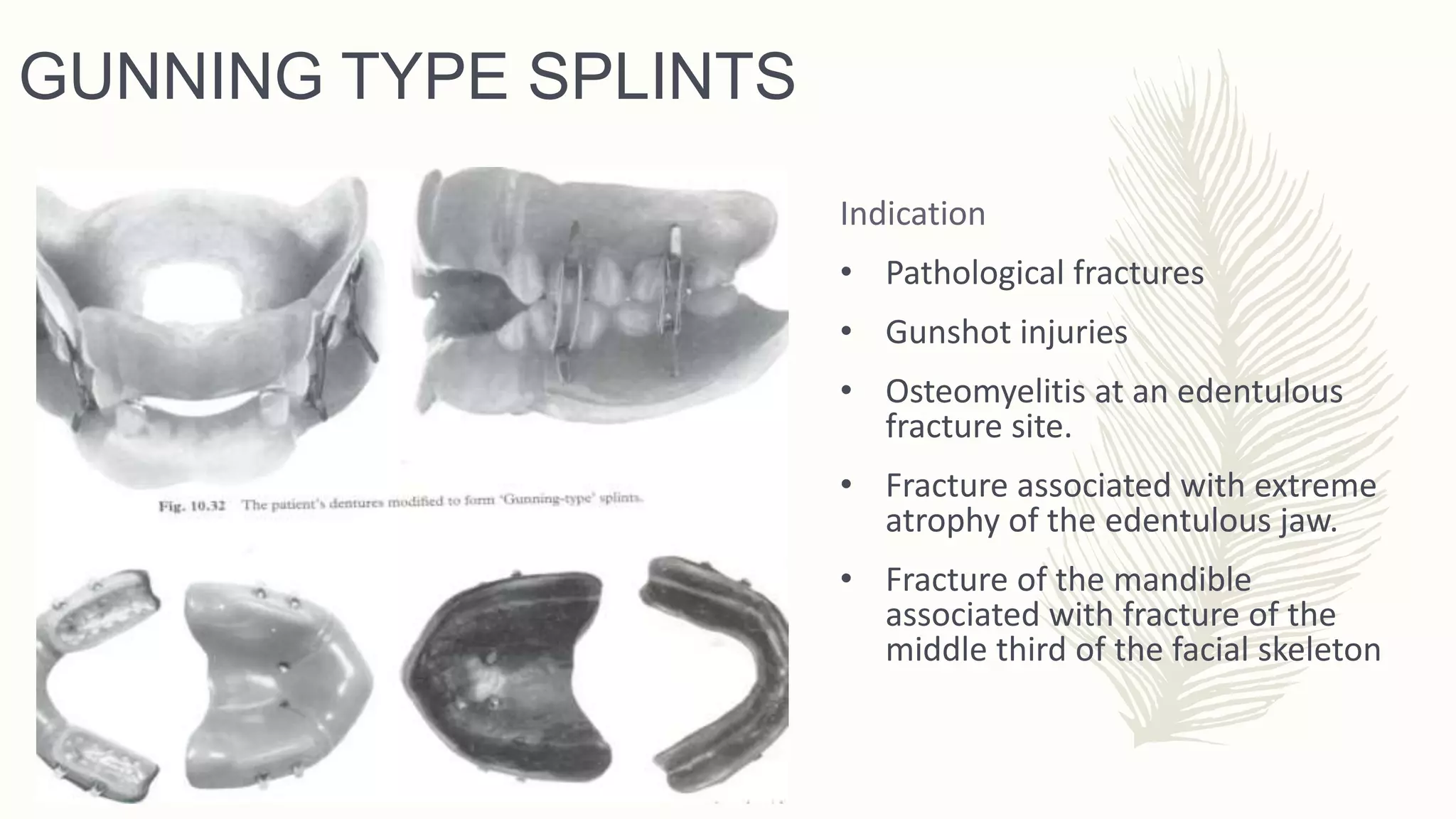 Mandibular Fracture.ppt