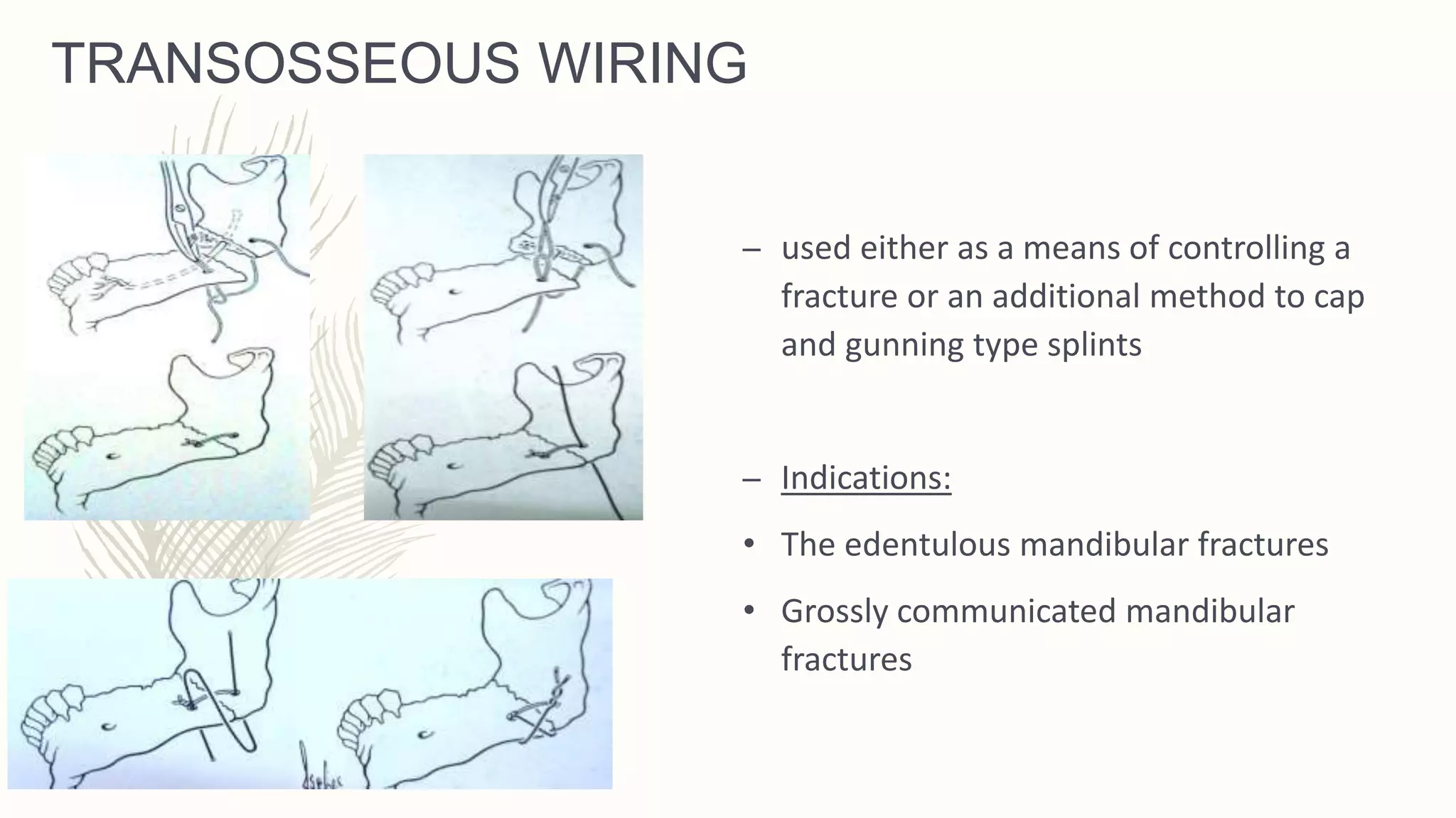 Mandibular Fracture.ppt