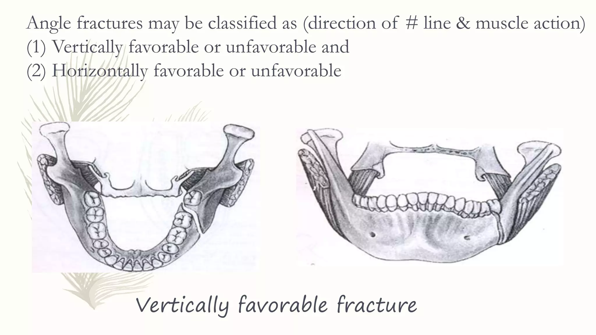 Mandibular Fracture.ppt