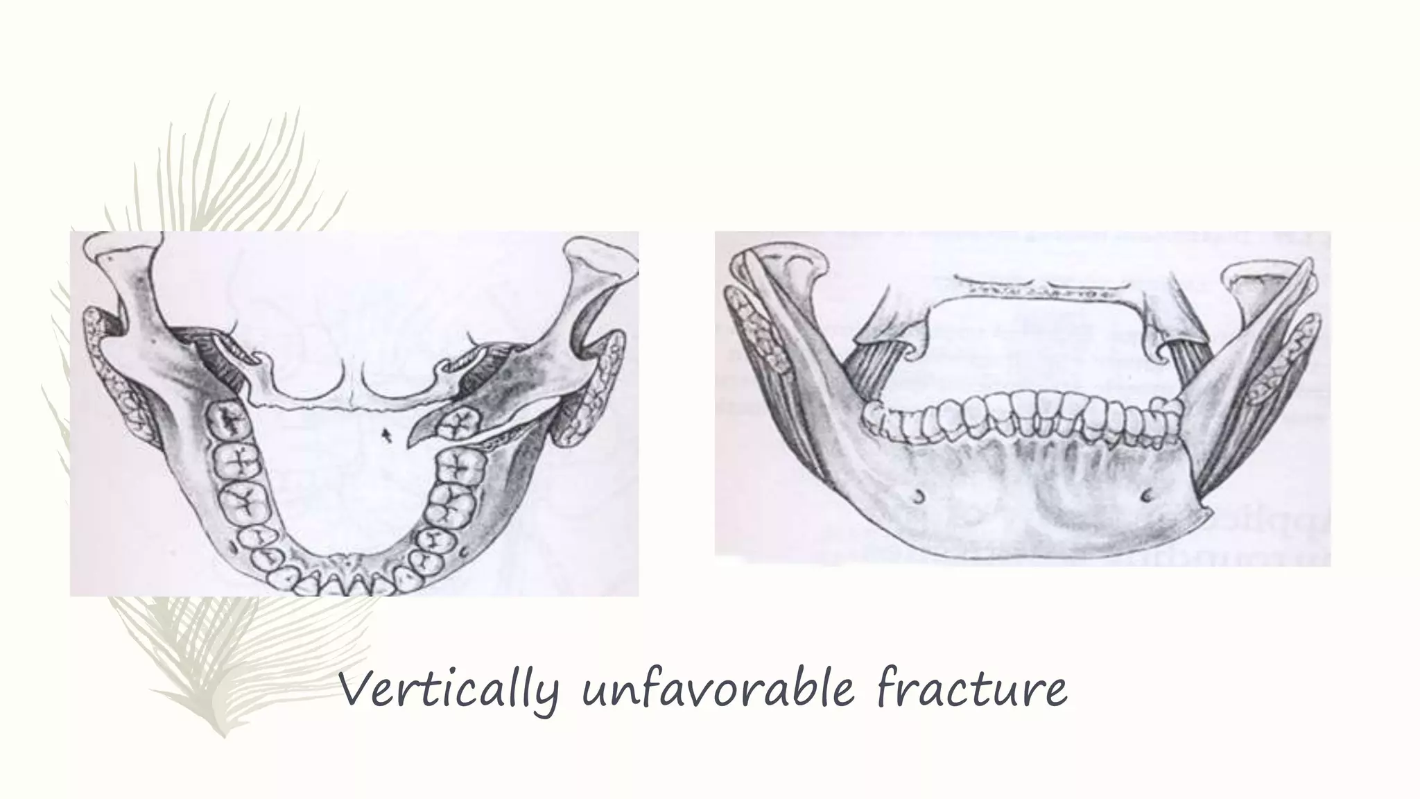 Mandibular Fracture.ppt