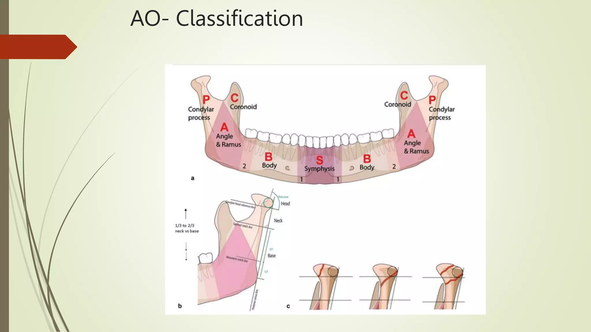 Mandibular Fracture.pptx