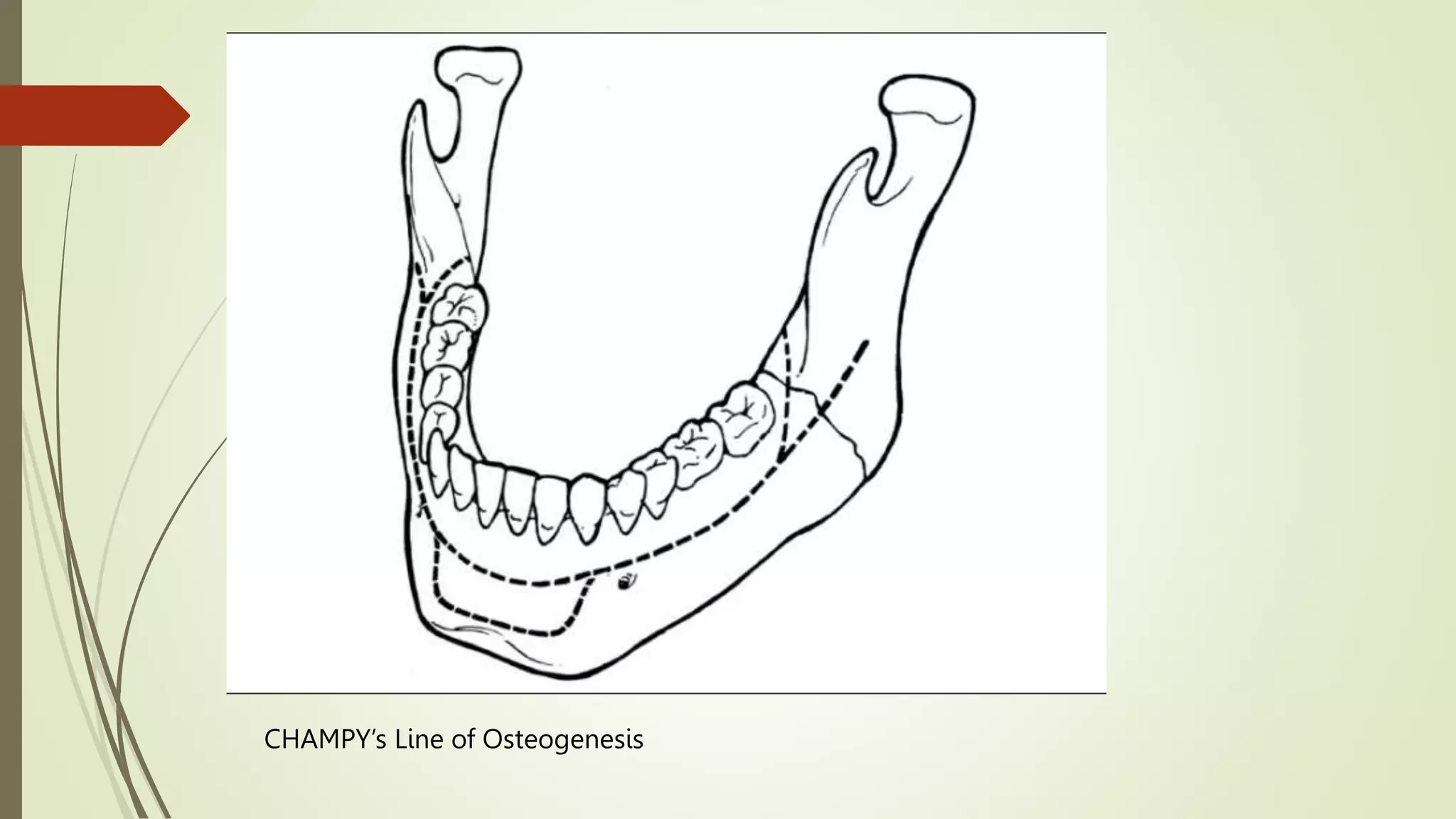 Mandibular Fracture.pptx