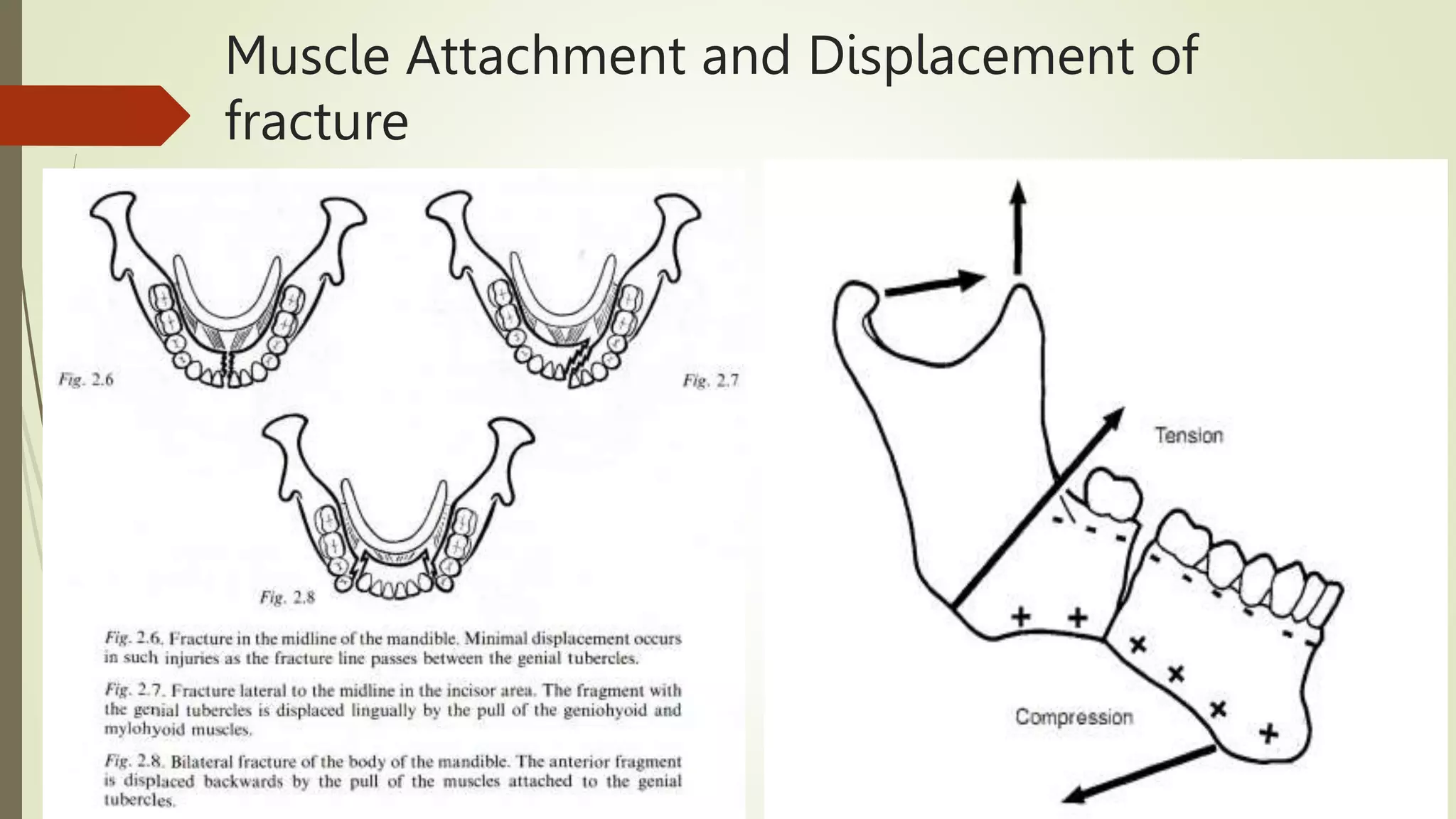 Mandibular Fracture.pptx