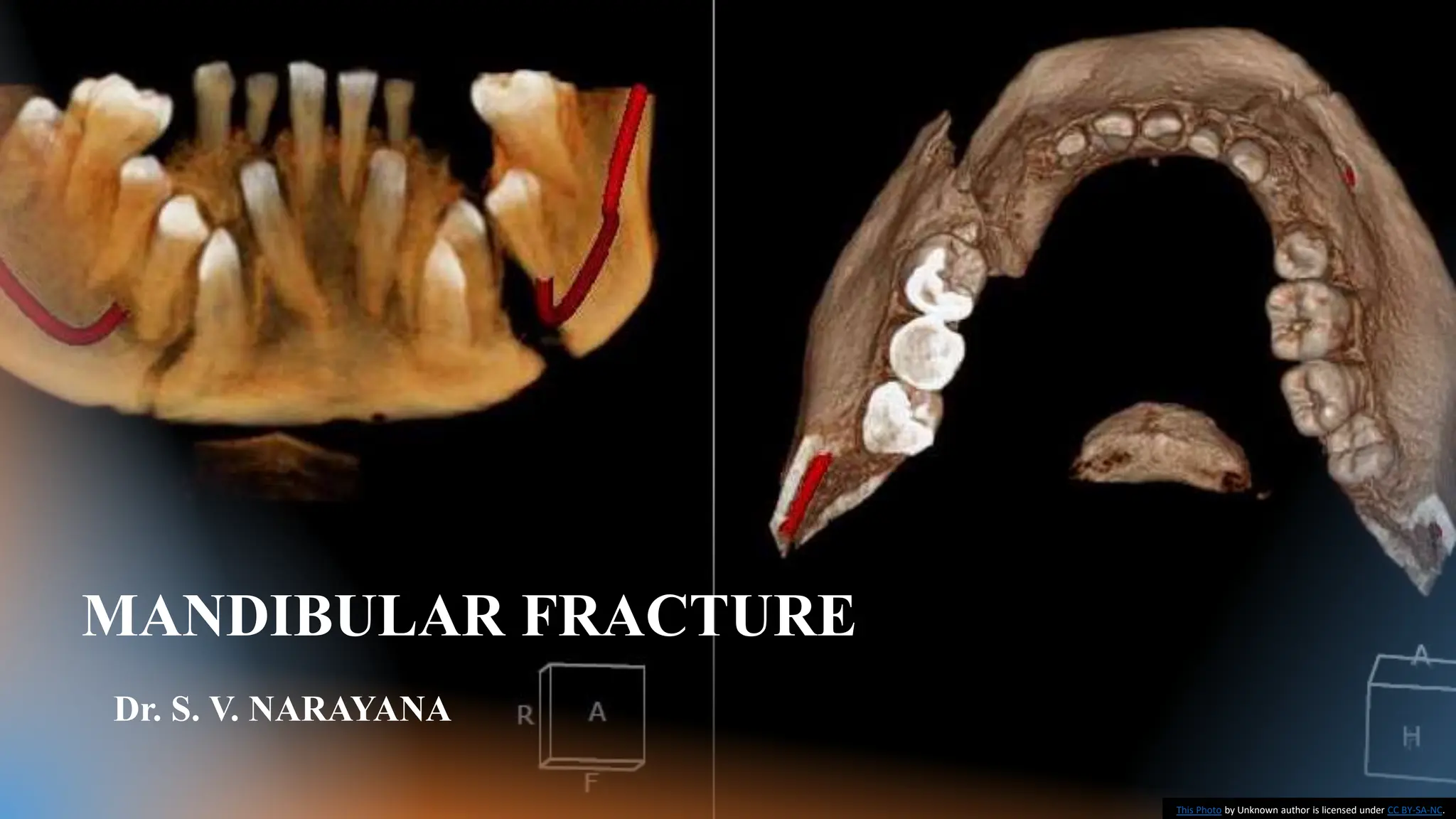 MANDIBULAR FRACTURE in plastic surgery.pptx