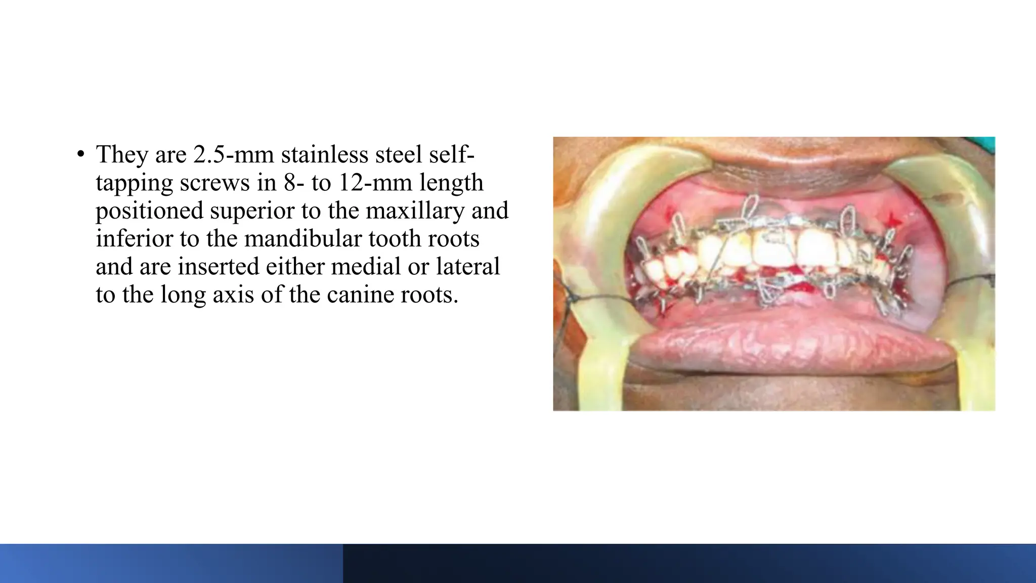 MANDIBULAR FRACTURE in plastic surgery.pptx