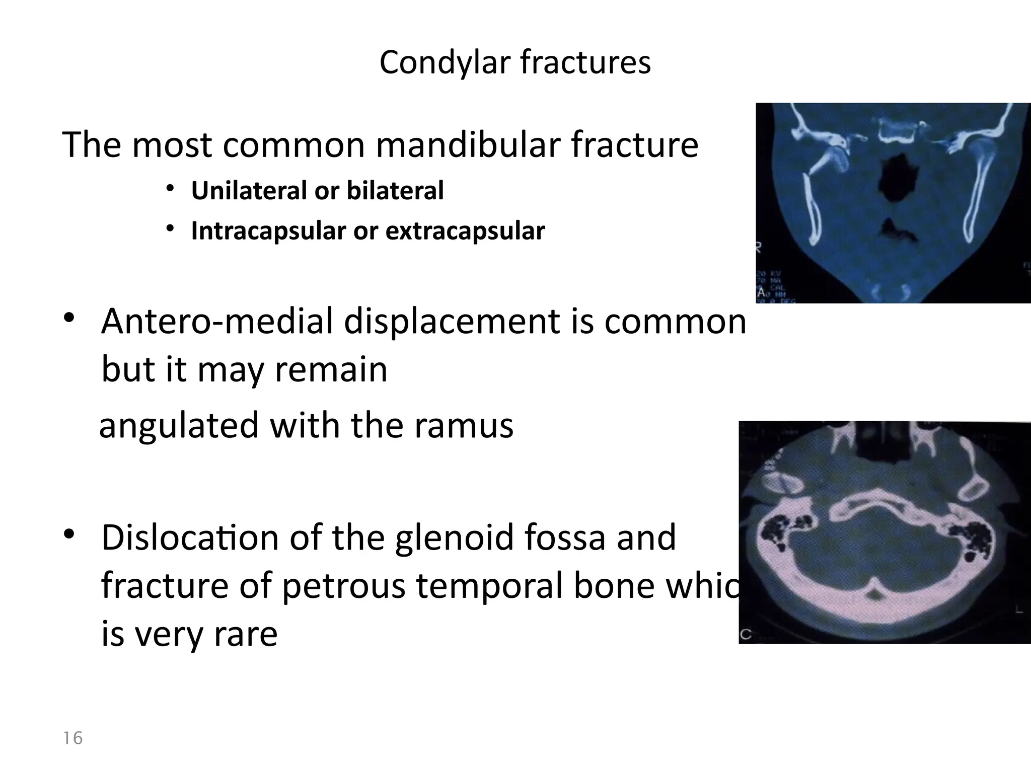 Mandibular Fracture .pptx