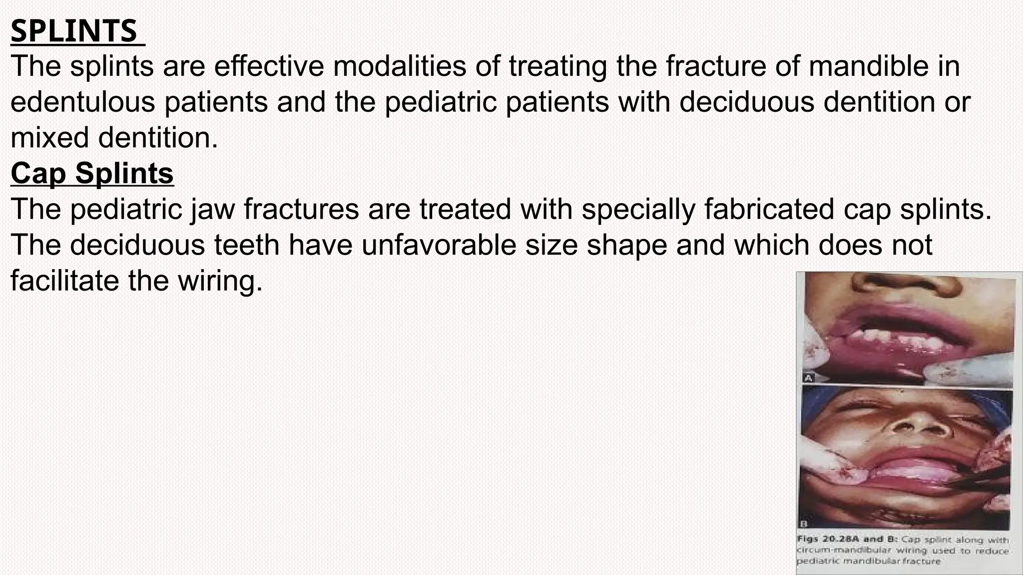 mandibular fracture_ chsdft aswiyshs.pptx
