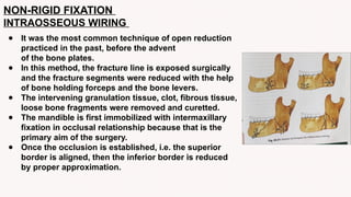 mandibular fracture_ chsdft aswiyshs.pptx