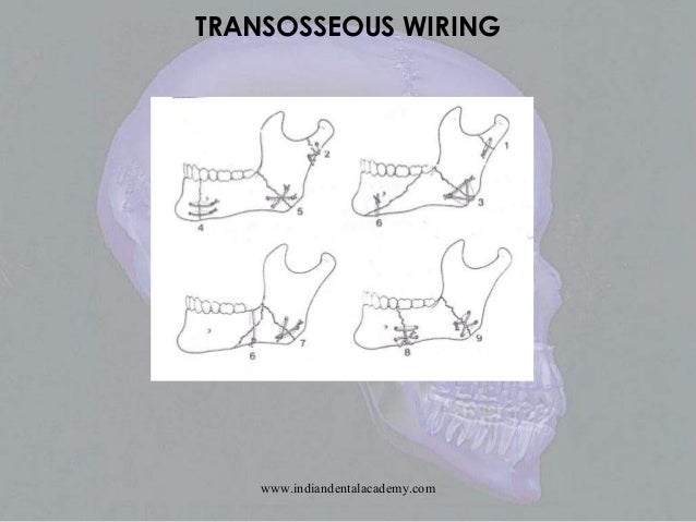 Mandibular fracture 3 / fixed orthodontic courses