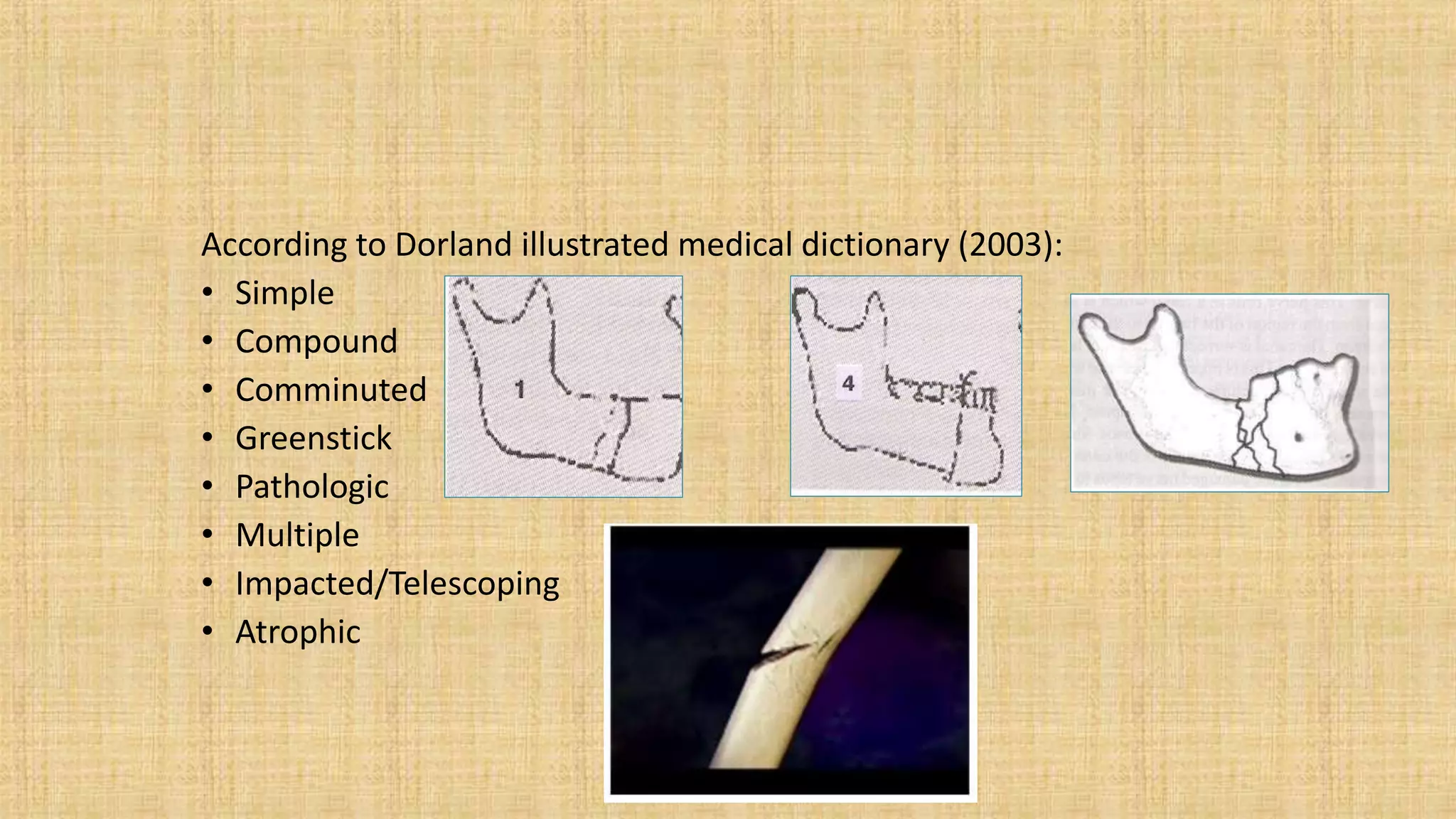 Mandibular fracture closed reduction | PPT