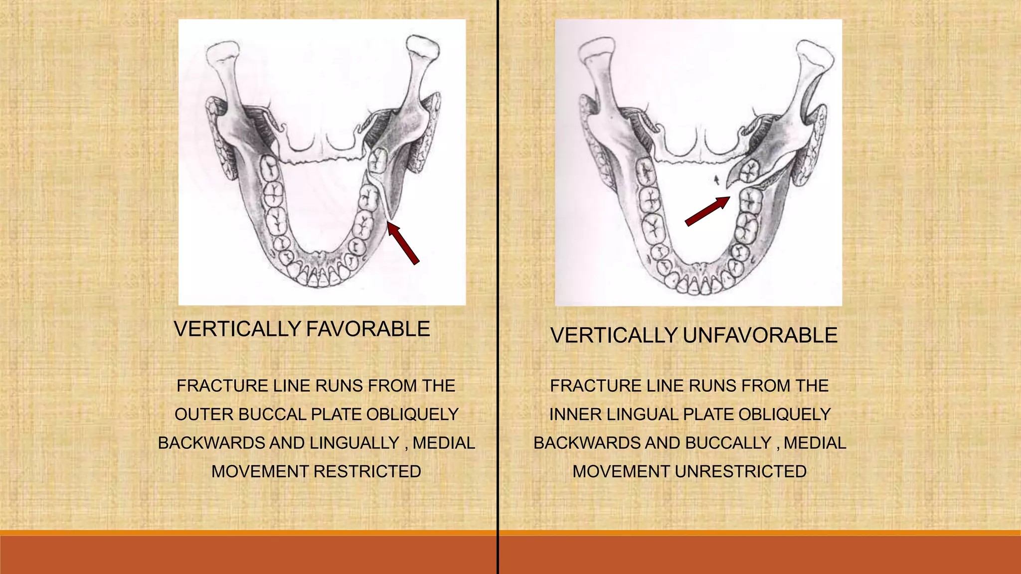 Mandibular fracture closed reduction | PPTX