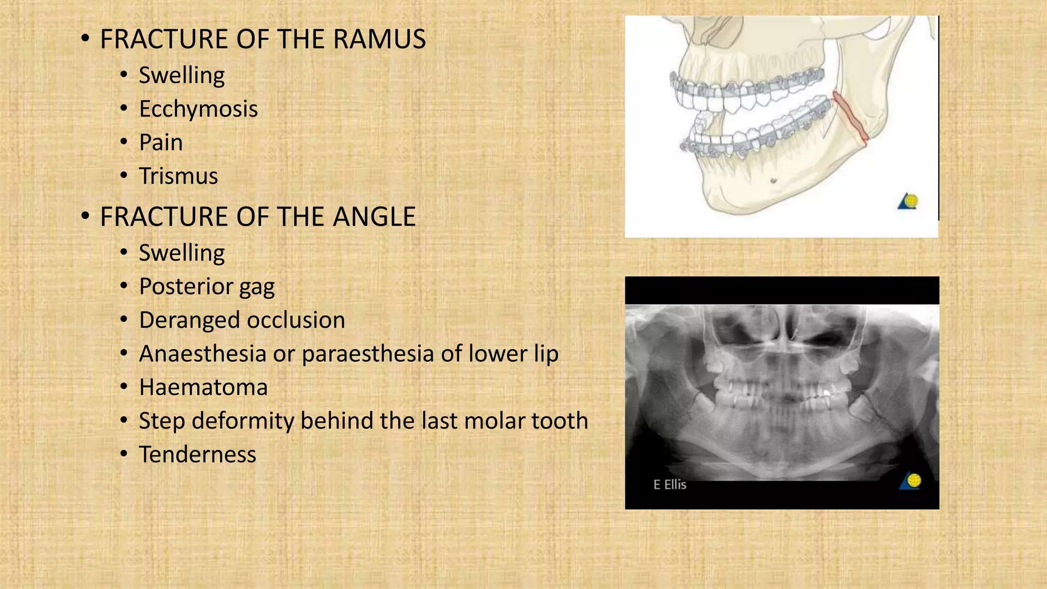 Mandibular fracture closed reduction | PPTX