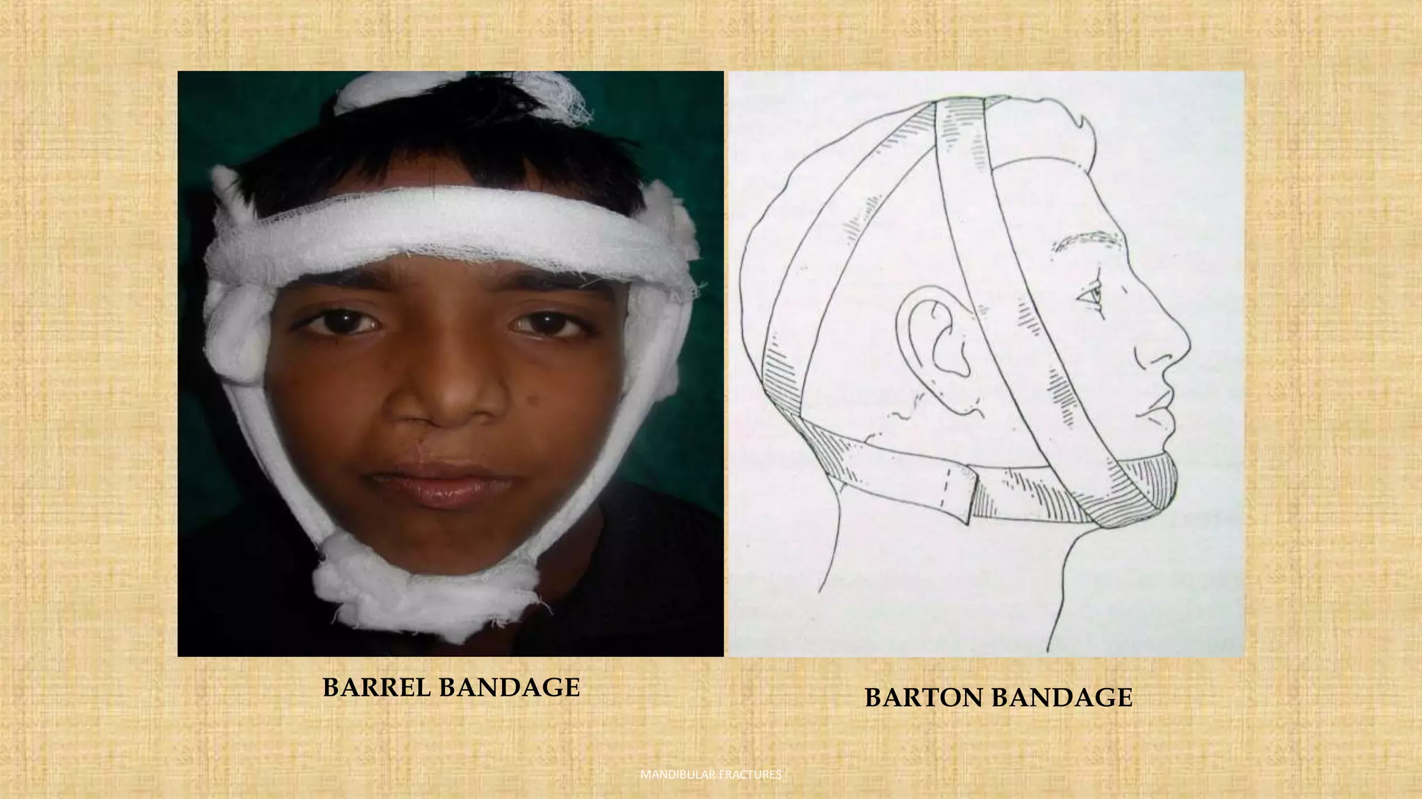 Mandibular fracture closed reduction | PPTX