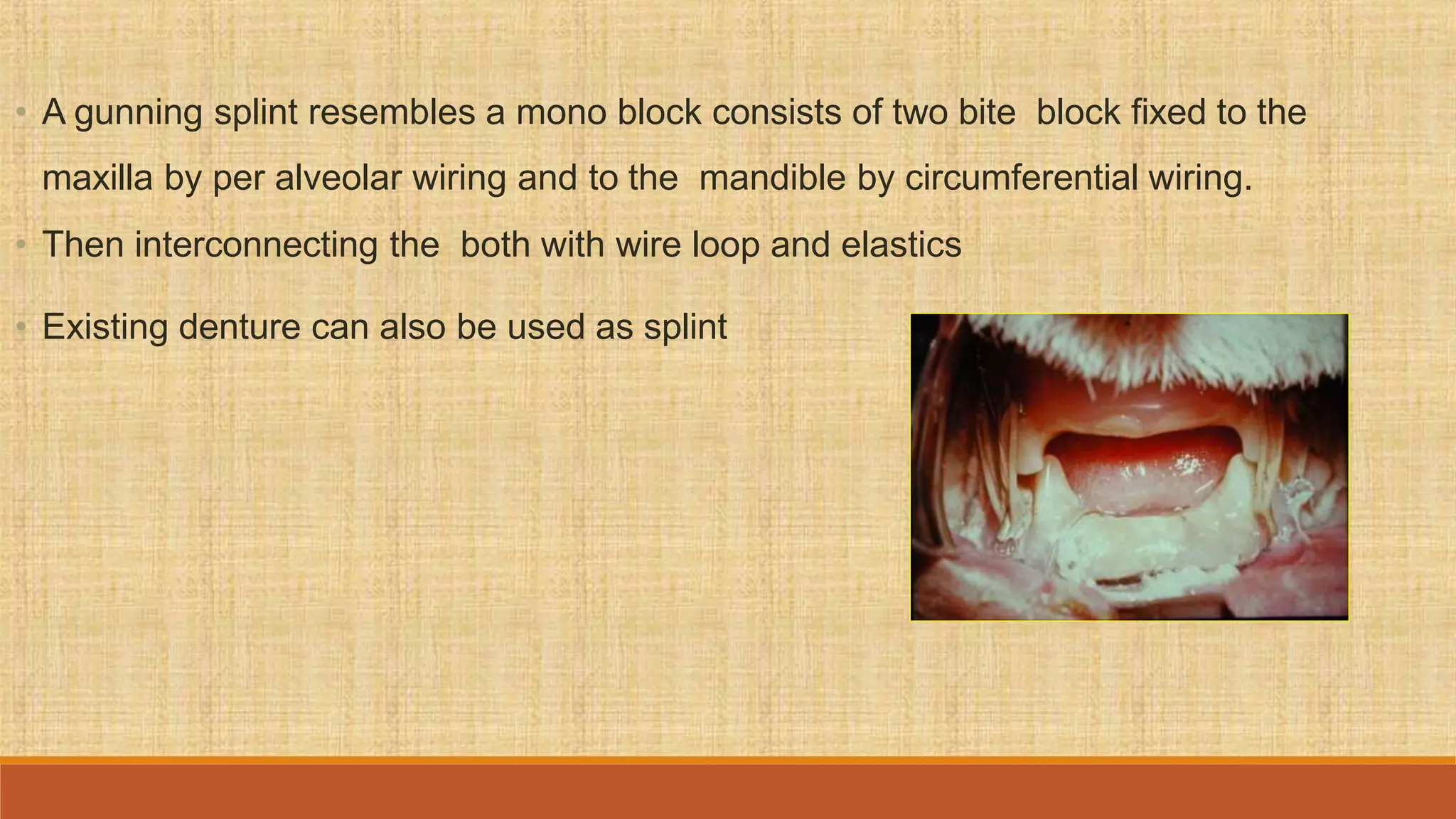 Mandibular fracture closed reduction | PPTX