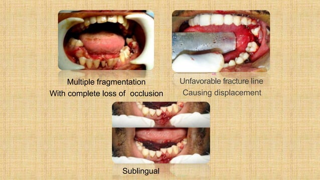 Mandibular Fracture Closed Reduction Ppt