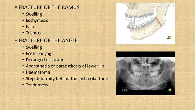 Mandibular fracture closed reduction | PPT