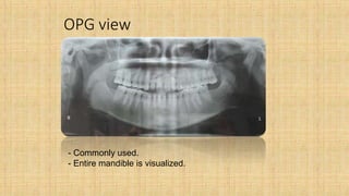 Mandibular fracture closed reduction | PPTX