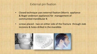 Mandibular fracture closed reduction | PPTX